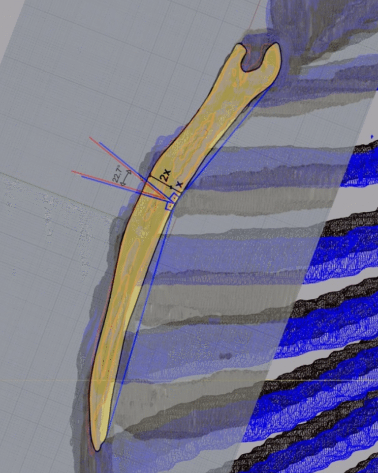 Ravitch Procedure - DR Pectus