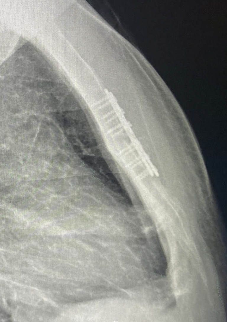 Ravitch Procedure - DR Pectus