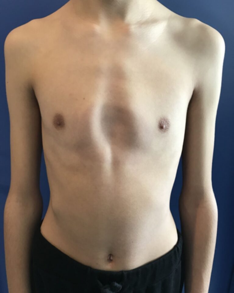 Ravitch Procedure - DR Pectus