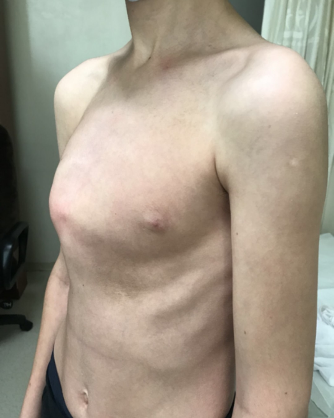 Ravitch Procedure - DR Pectus