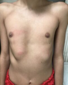 Ravitch Procedure - DR Pectus